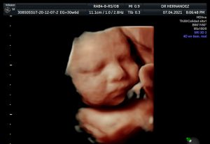 Ultrasonido 4d - Ver el rostro y la anatomía del bebé con nitidez y ...